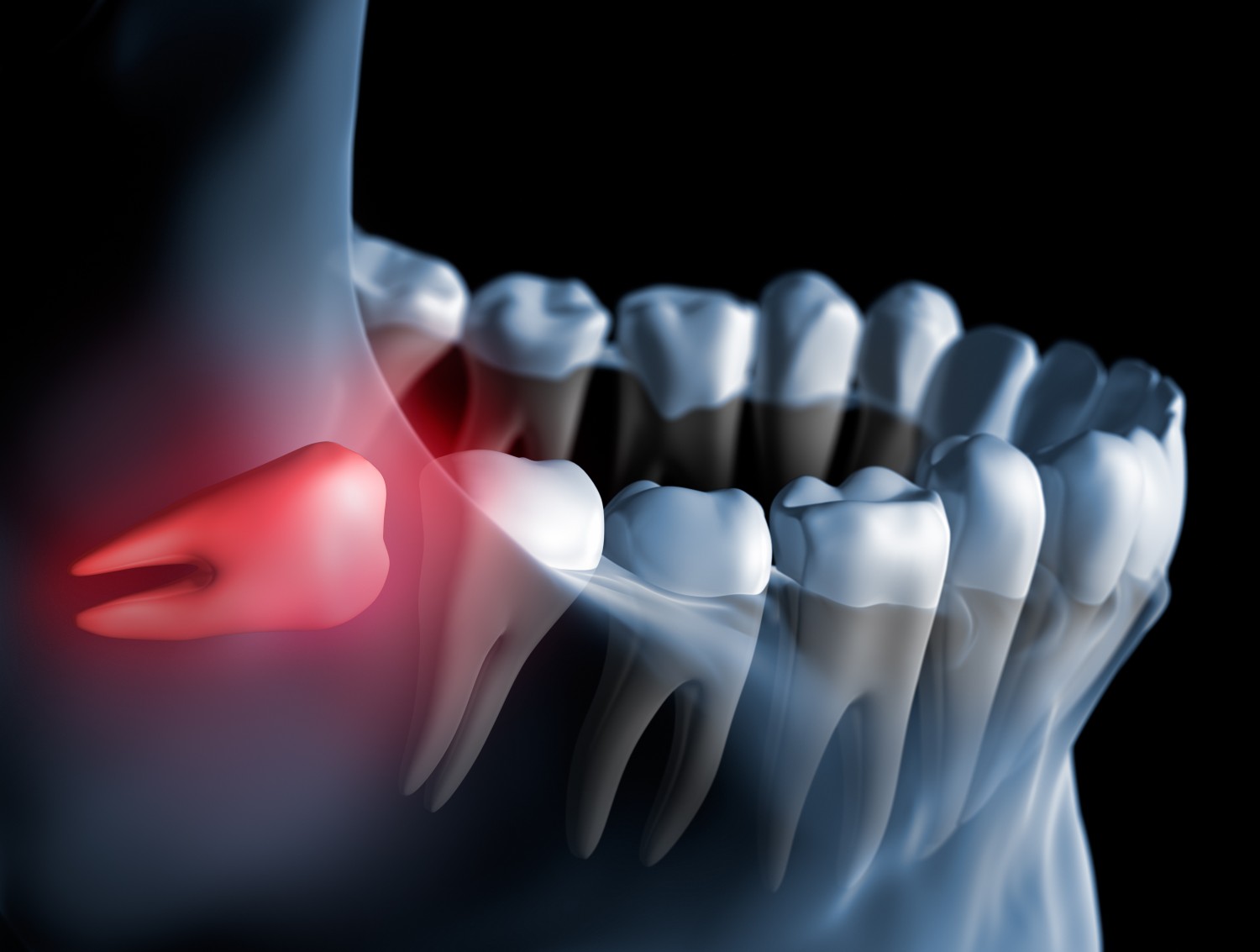 WISDOM TEETH | Dentist In Ottawa | Dr Lama Ghantous